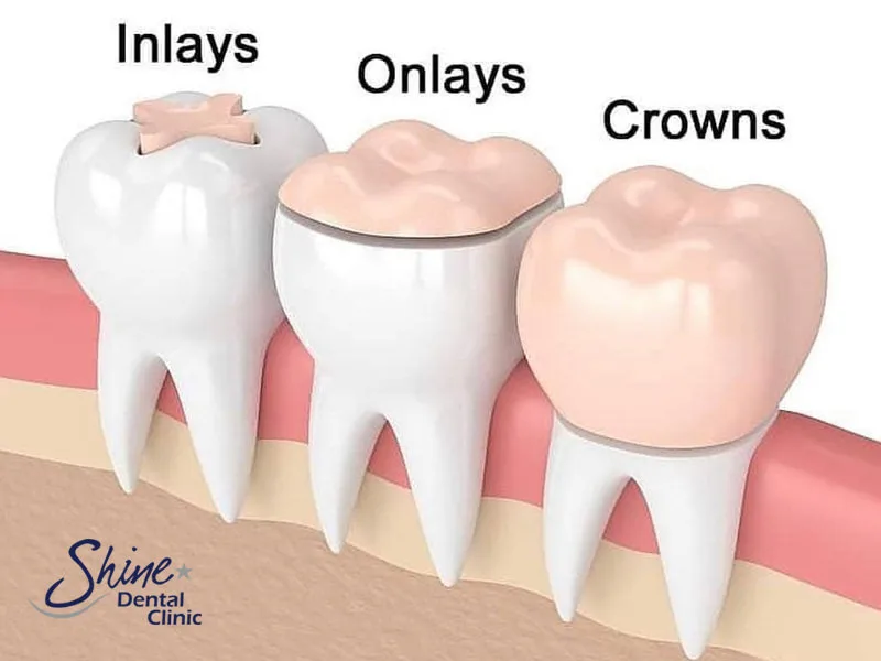 Crown Inlay Inlay, Onlay Für Zähne In Zagreb, Kroatien | B.DENT