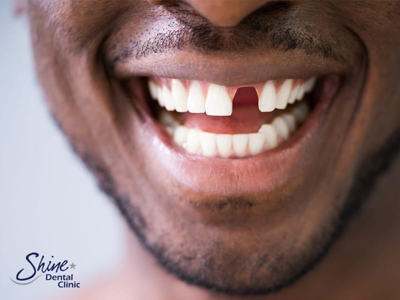 What Are My Options if I Have Missing Teeth? - Dentist Four Marks