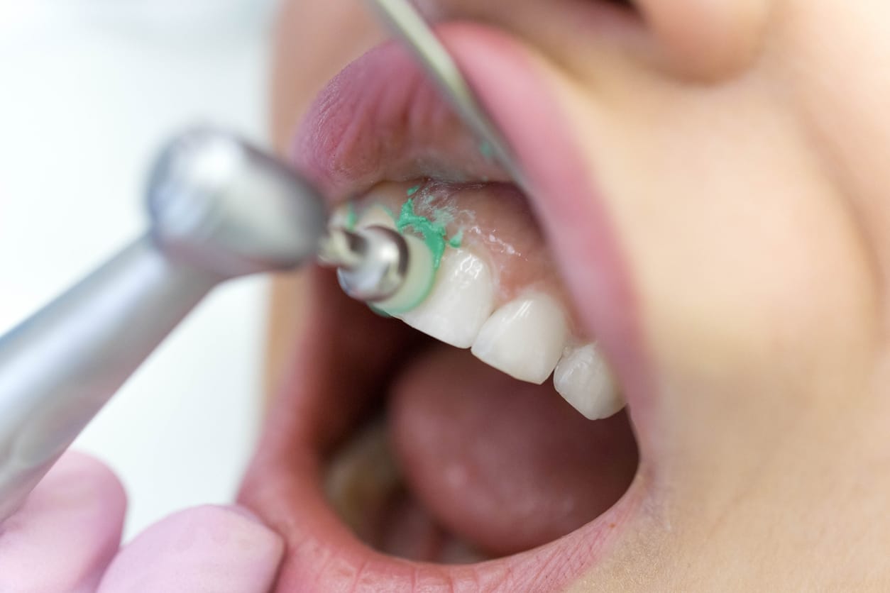 Dental Microabrasion Four Marks - Remove Stains on Teeth in Alton